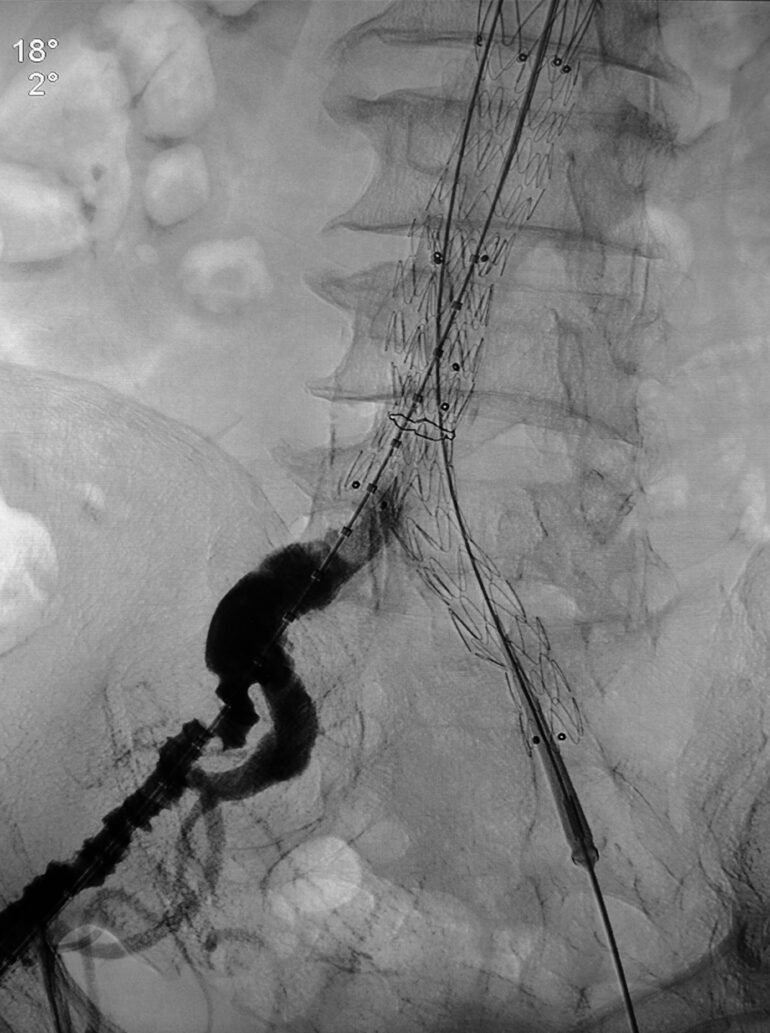 Endovascular Aneurysm Repair (EVAR) for Abdominal Aortic Aneurysms