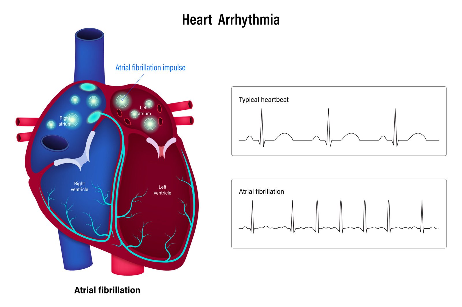 Pulsed Field Ablation (PFA): Advanced Atrial Fibrillation Care