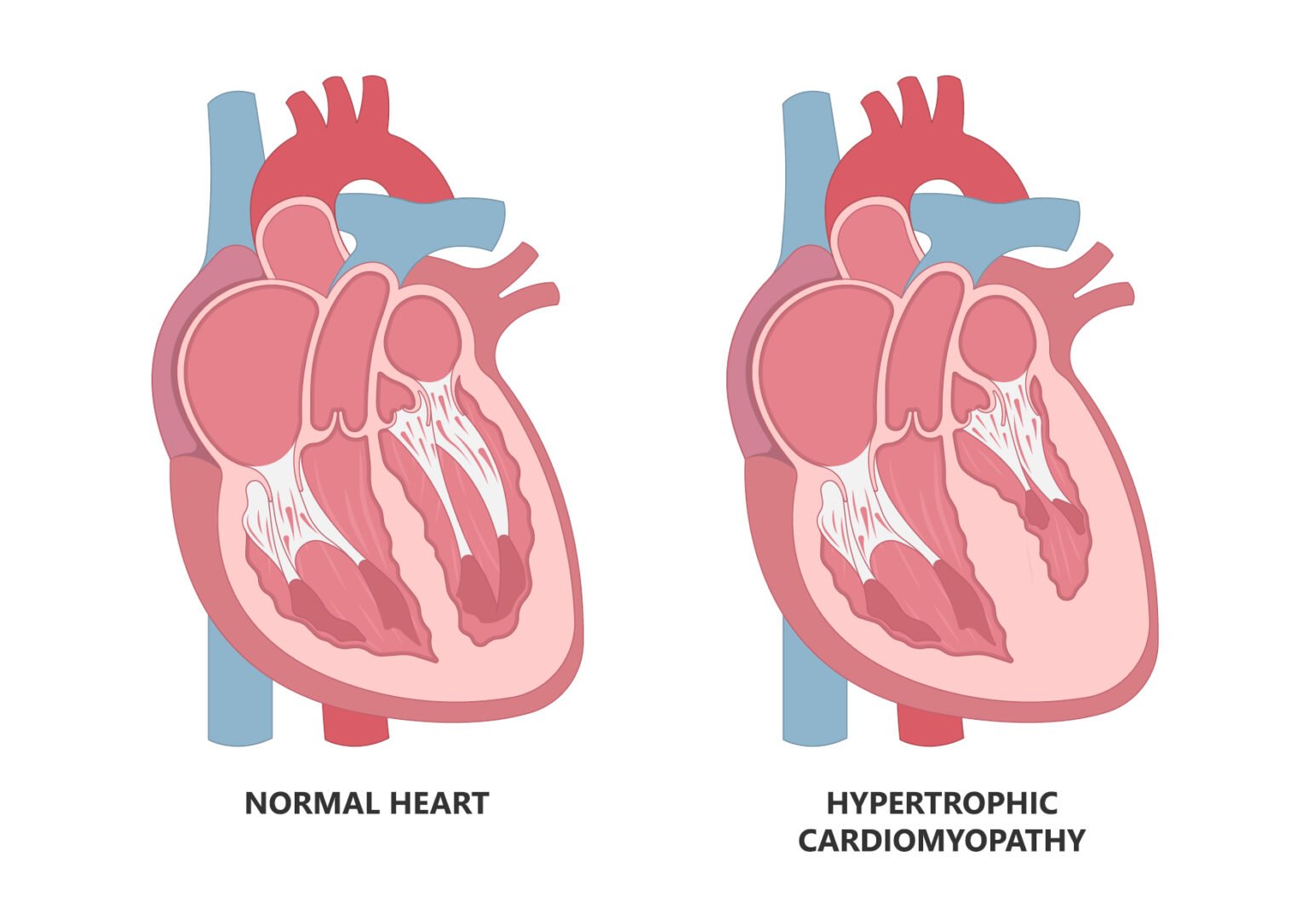Cardiomyopathy Causes, Symptoms & Treatments