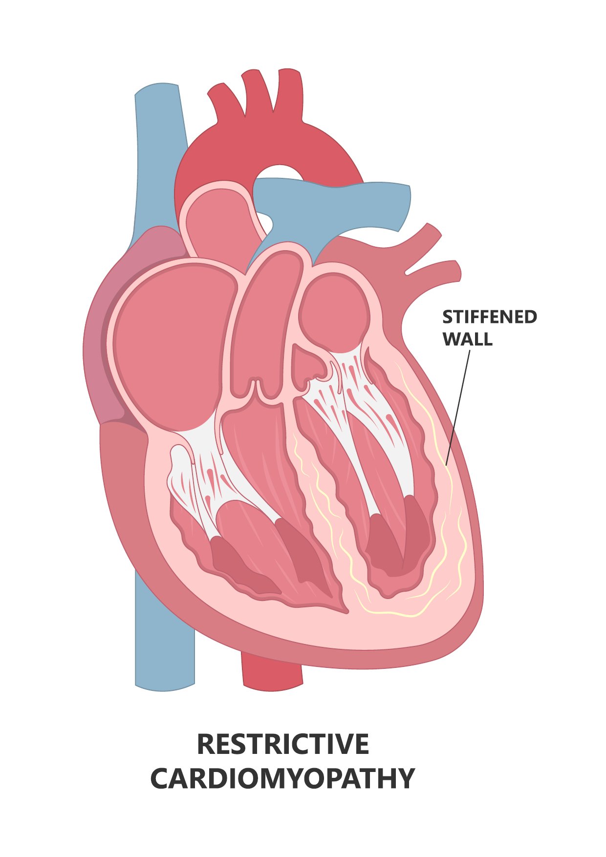 Cardiomyopathy Causes, Symptoms & Treatments