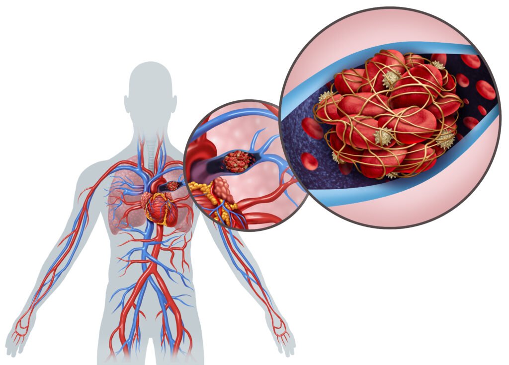 Your Guide to Pulmonary Embolism and Recovery