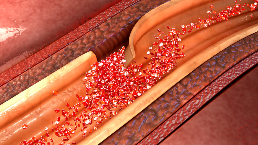 Aortic Dissection: Early Detection, Treatment & Prevention