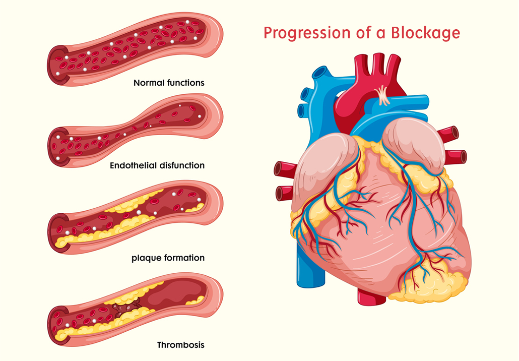 Symptoms of Heart Blockage You Should Never Ignore
